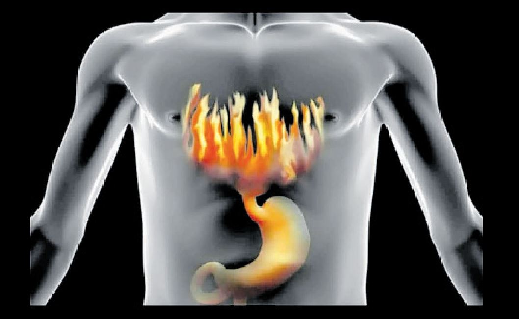 Watch that ‘burning’ sensation in your chest - The Citizen