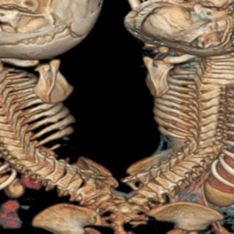 World watches as Tanzanian twins undergo rare surgery - The Citizen