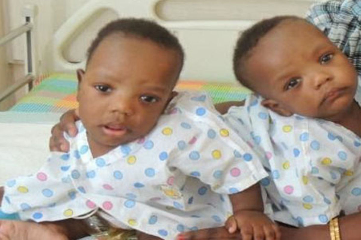Tz twins survive record operation | The Citizen