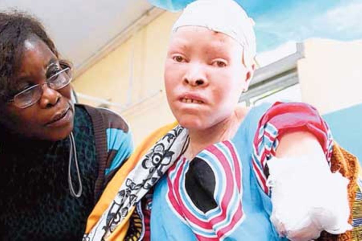 COMPLAINT: Campaign to protect albinos lacks steam,activists charge ...