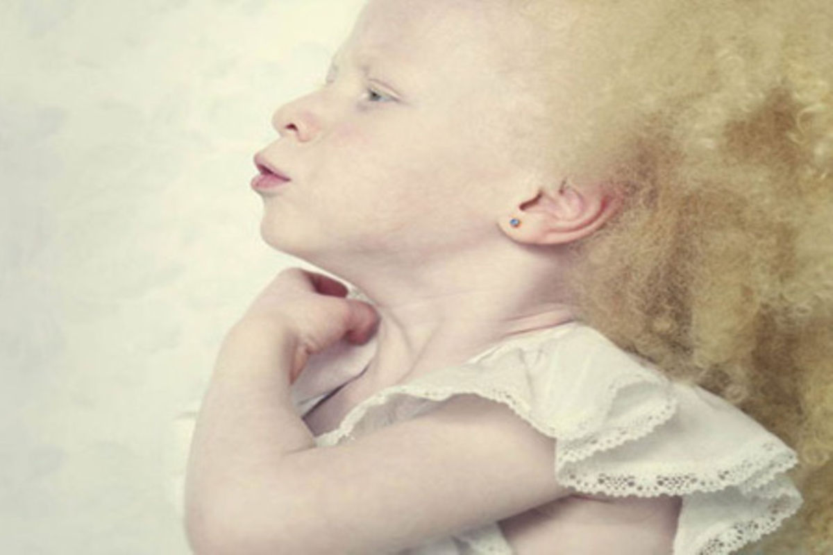 90 per cent of albinos with skin cancer die, body says | The Citizen