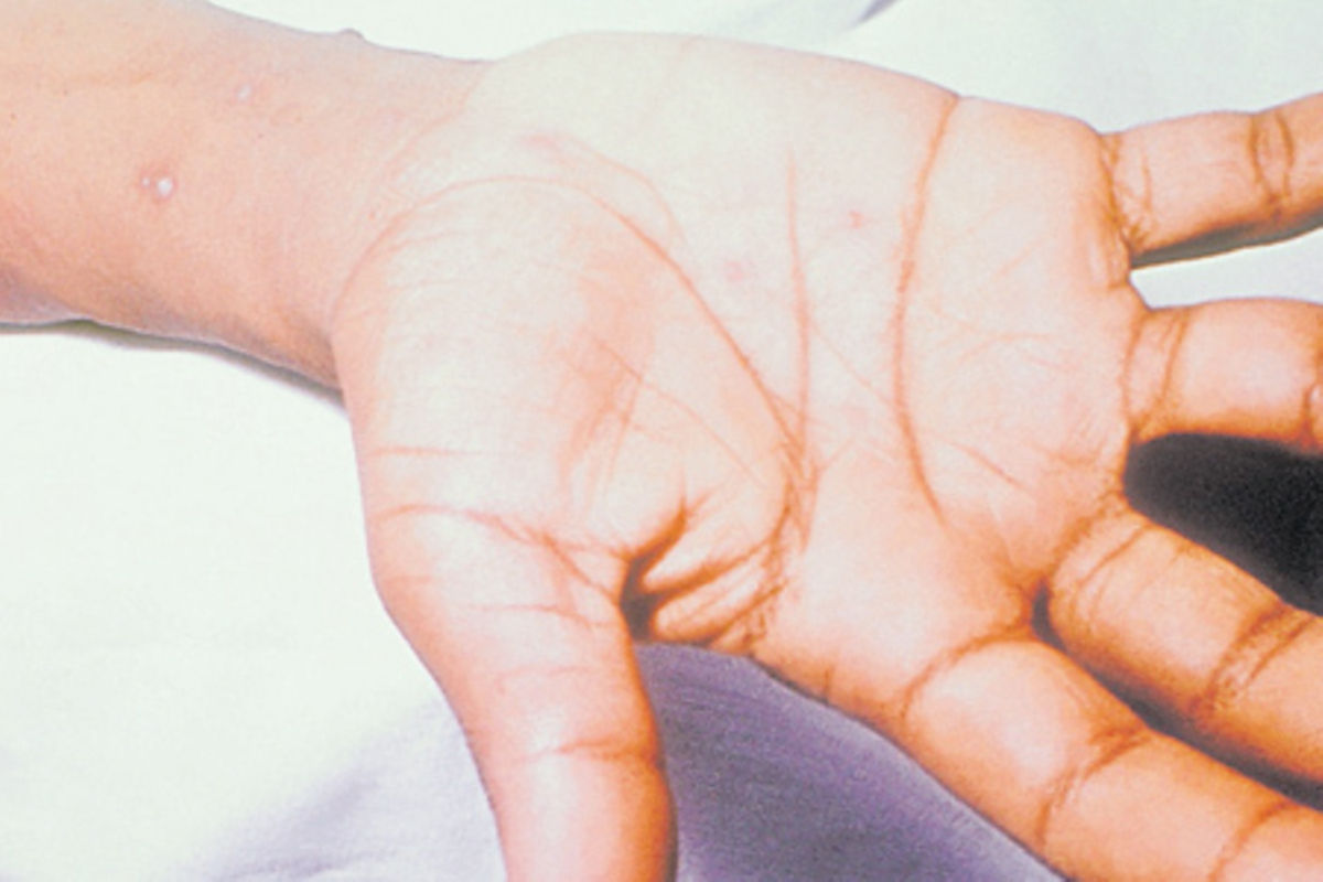 If you have low immunity, chicken pox can recur | The Citizen