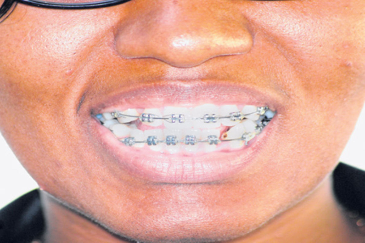 Bad teeth plagued Agnes’s confidence for almost 27 years | The Citizen