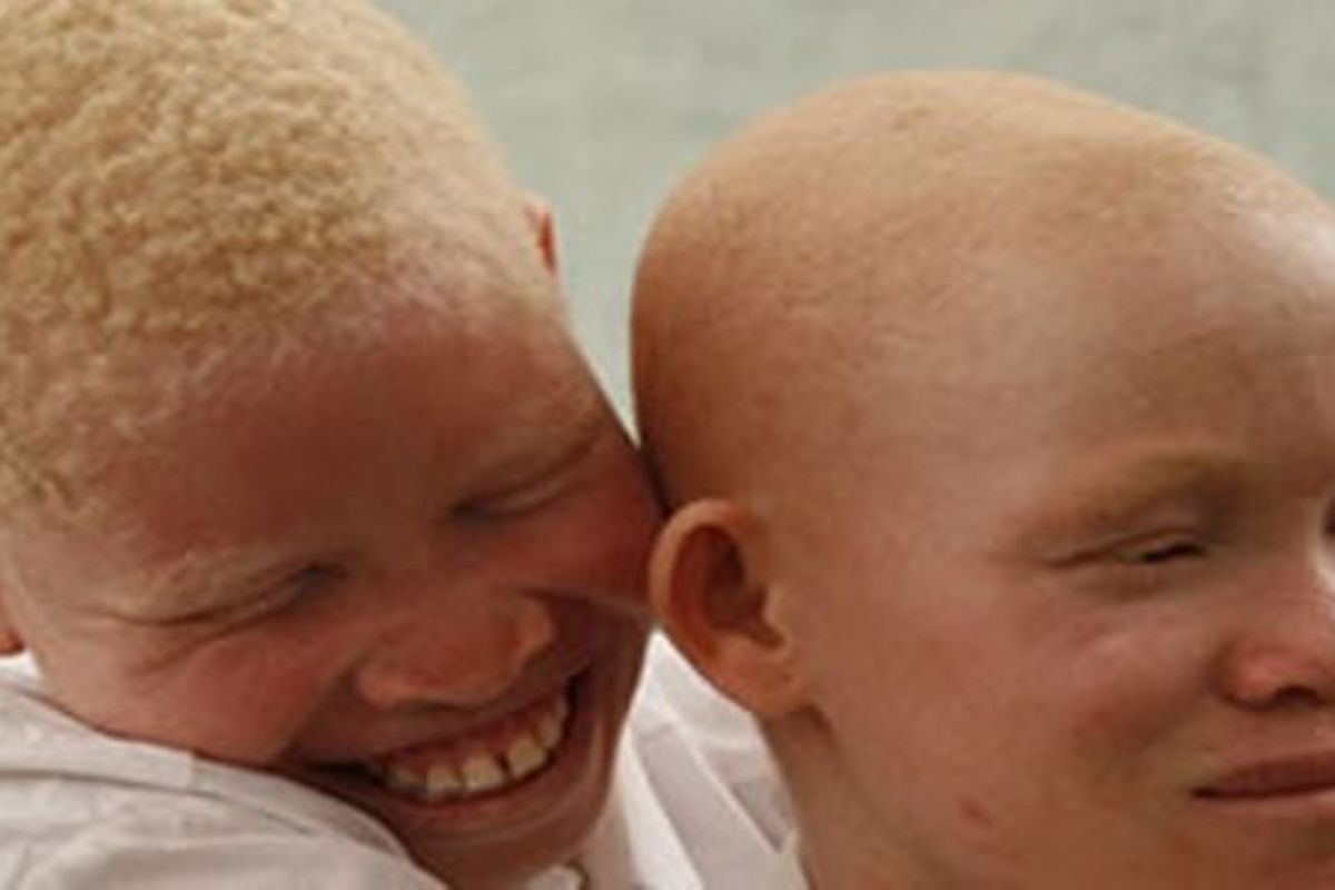 Albinos still face tests despite protection efforts | The Citizen