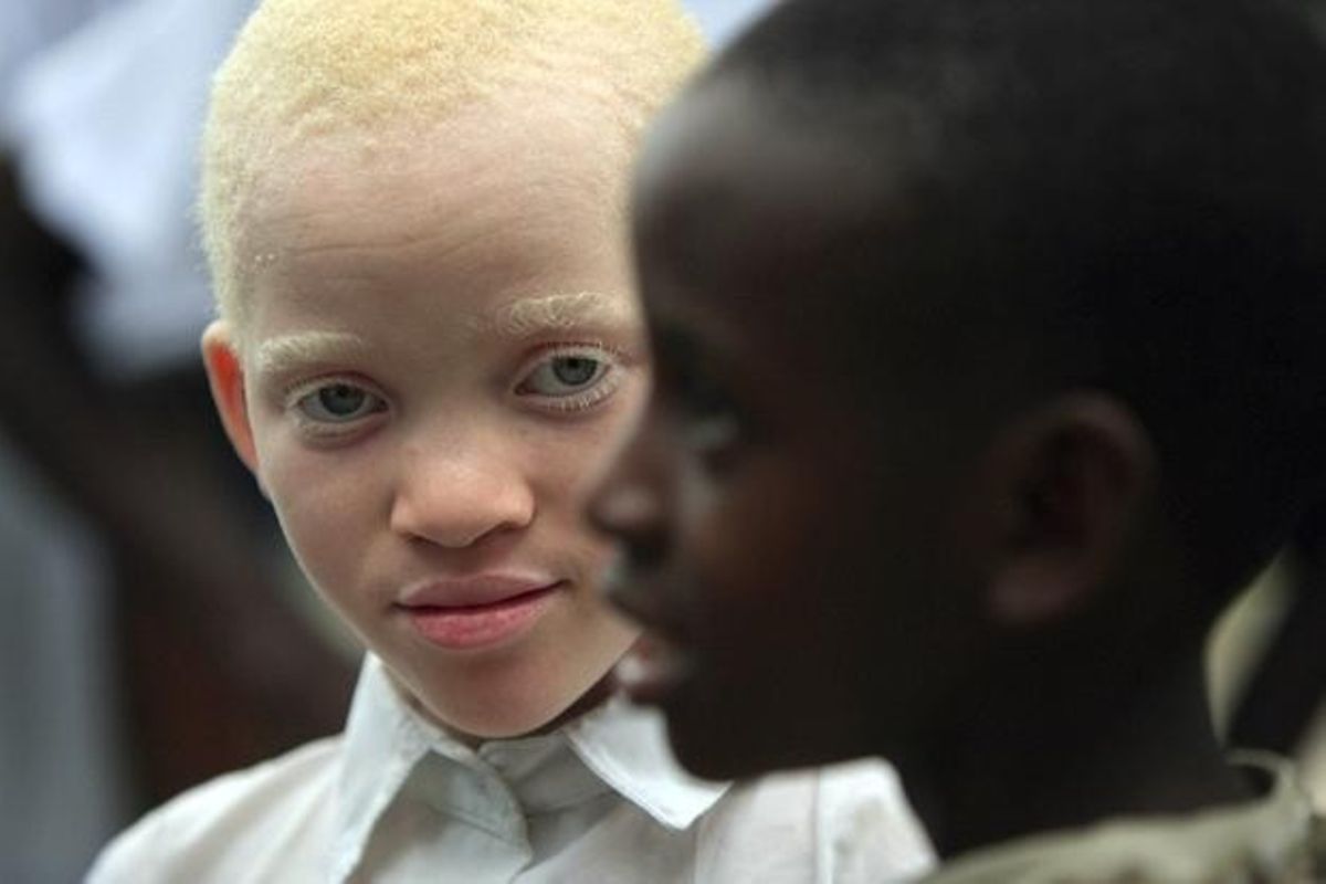 Children living with albinism start reuniting with families | The Citizen