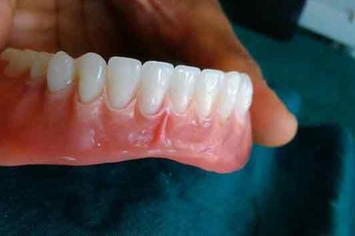 What you should know about artificial teeth | The Citizen