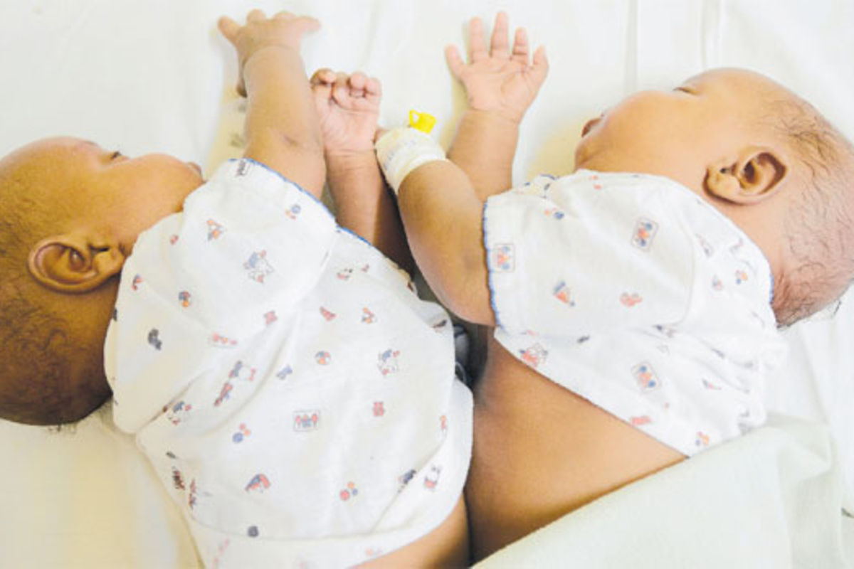 The hands that freed Kisarawe conjoined twins | The Citizen