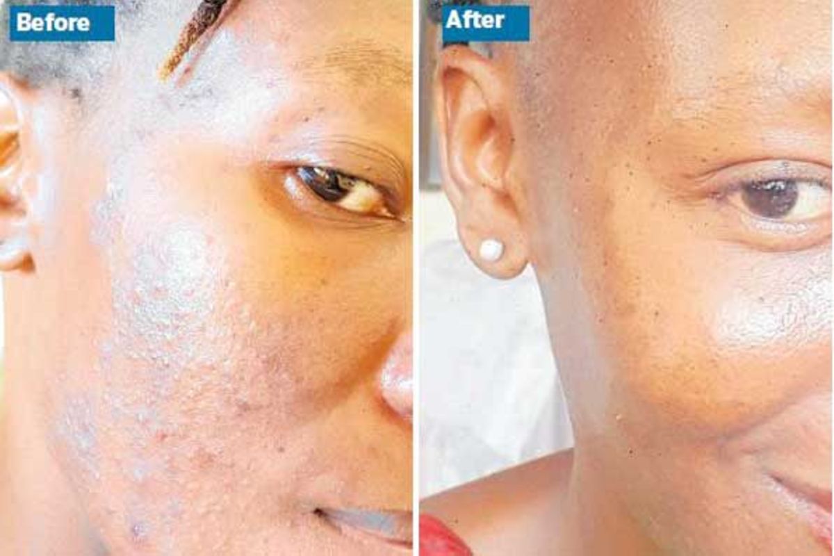 My painful journey in treating severe acne | The Citizen