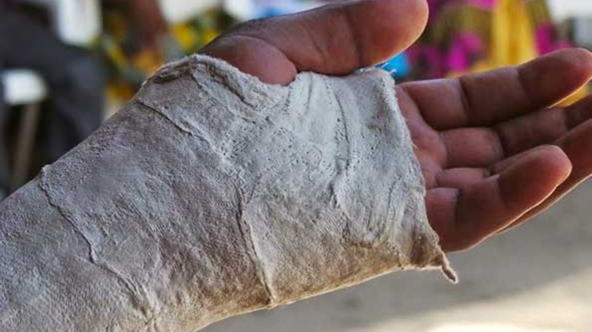 Shock, disbelief for family as boy’s hand amputated - The Citizen