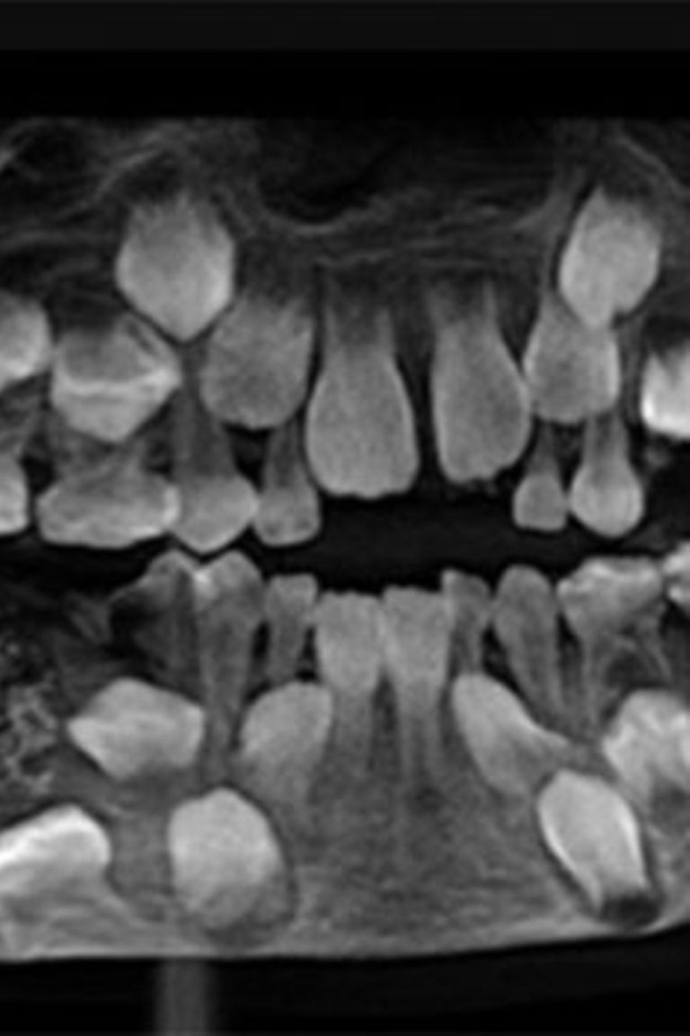 Indian boy, seven, found with 526 teeth inside his mouth - The Citizen