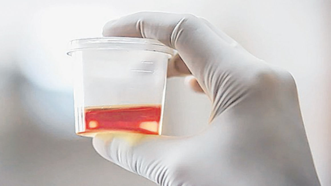 Blood in the urine: Possible causes of this strange sign - The Citizen