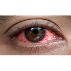 Understanding the red eye infection that has hit Dar | The Citizen