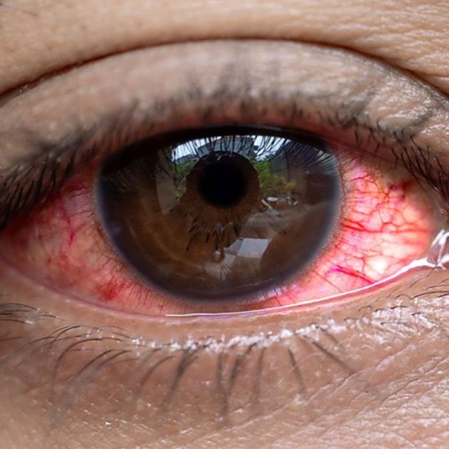 Seven people go blind in Zanzibar after using traditional remedies to ...