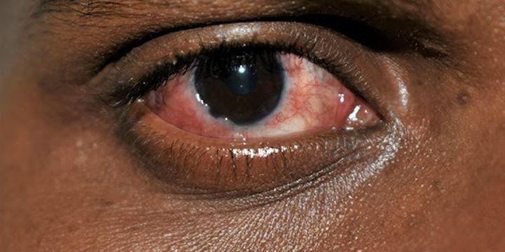 Seven people go blind in Zanzibar after using traditional remedies to ...