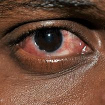 Govt warns over local remedies as ‘red eyes’ spreads to six 23 regions ...