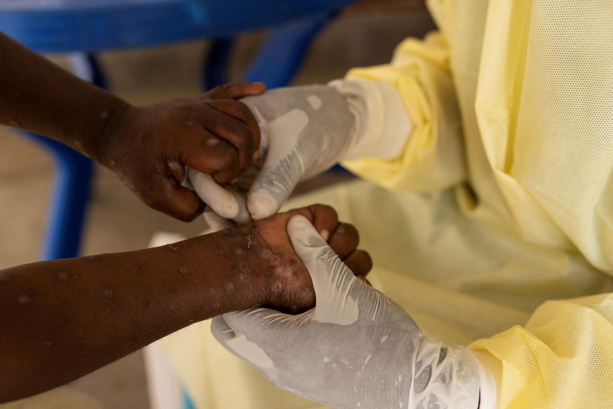 Kenya confirms first monkeypox case near border with Tanzania | The Citizen