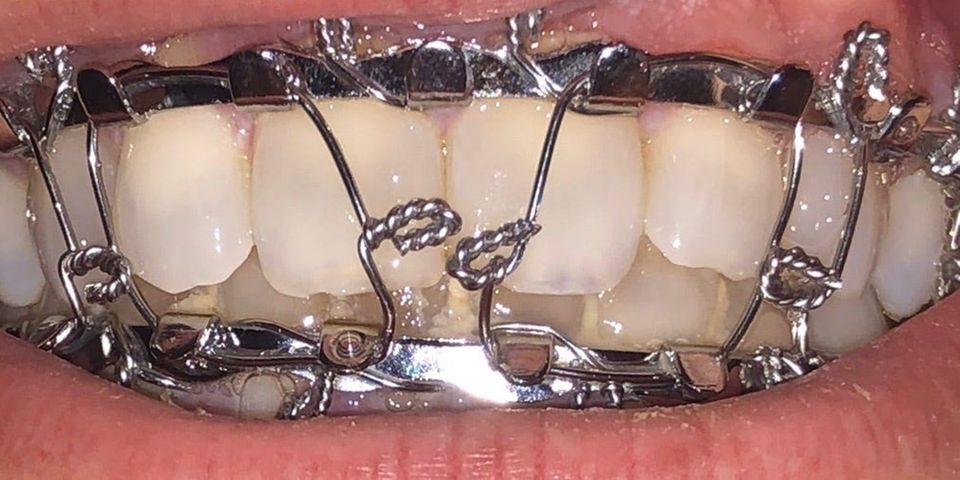 Concern as young women turn to jaw-wiring for weight loss | The Citizen